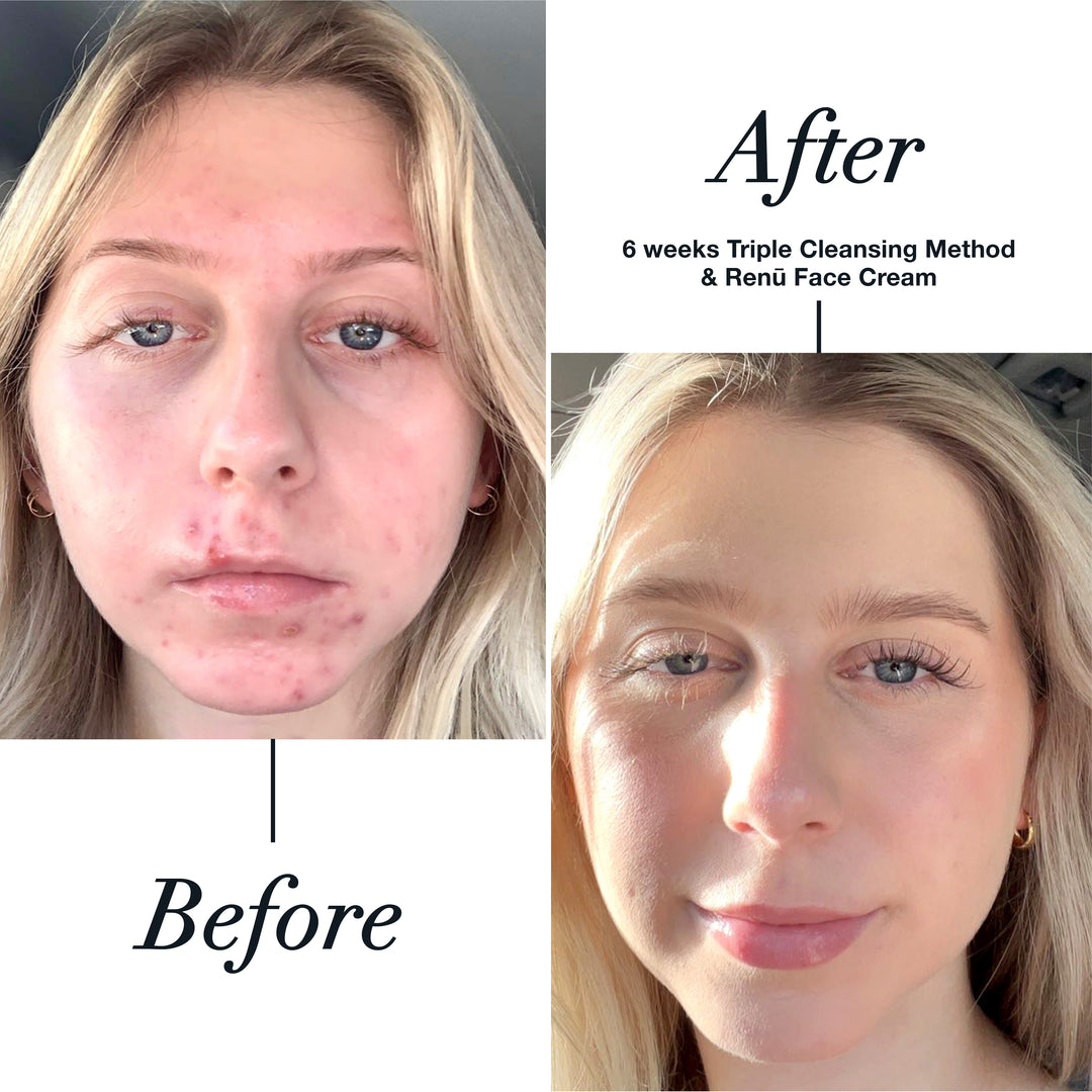 before and afters – Kindness Powered Skincare