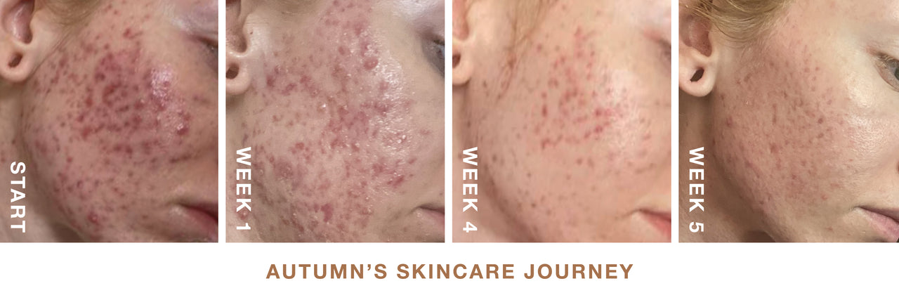 before and afters – Kindness Powered Skincare