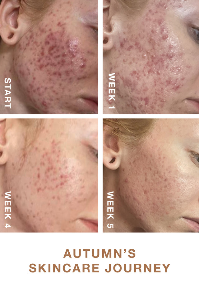 before and afters – Kindness Powered Skincare